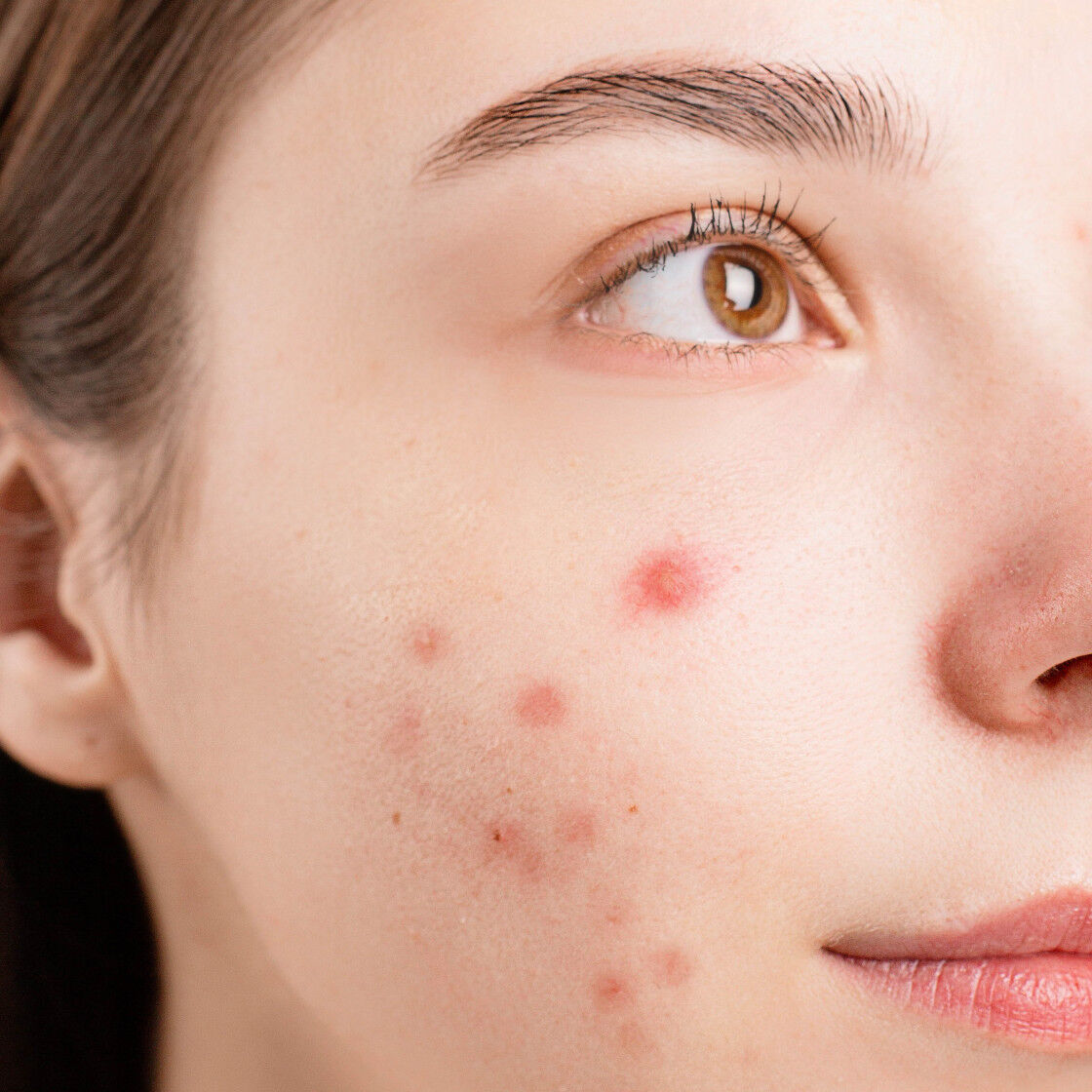 Trądzik hormonalny przyczyny objawy i leczenie Cetaphil